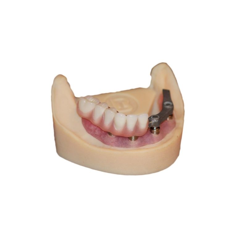 Friction Fit Integrated Bar Overdenture - New Image Dental Laboratory