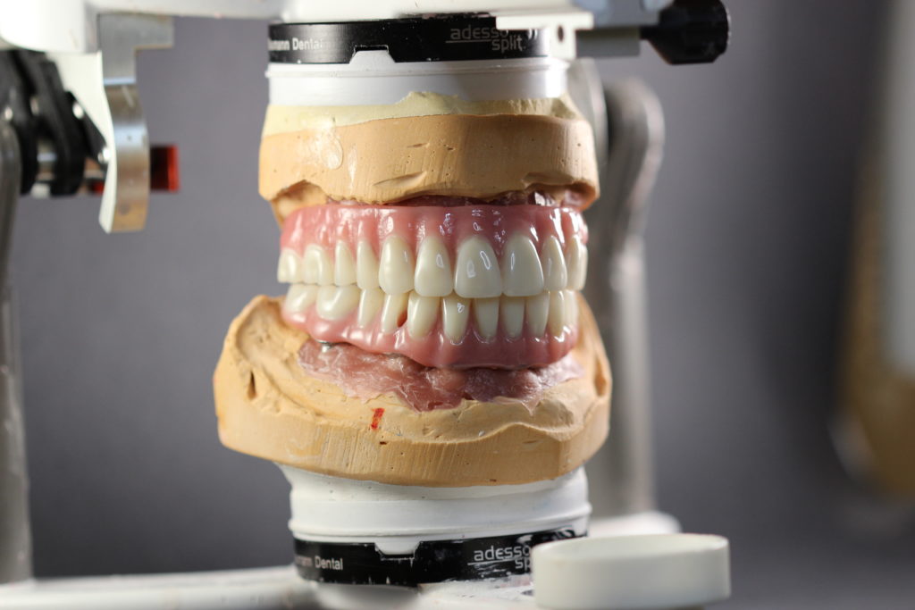 Screw-Retained Milled Titanium Bar with Acrylic Hybrid - New Image ...