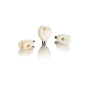 Screw-Retained Restorations - New Image Dental Laboratory